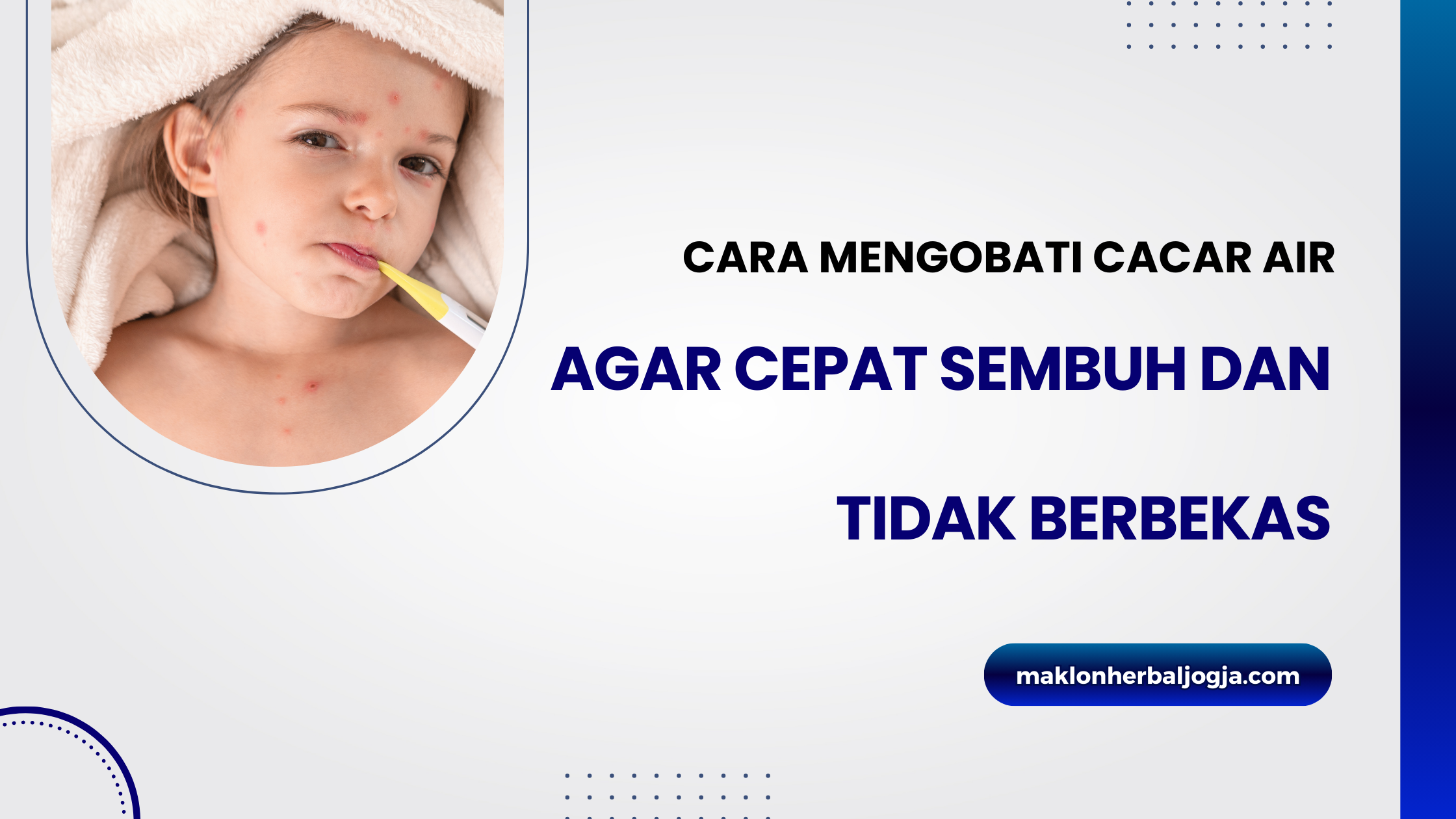 Cara Mengobati Cacar Air agar Cepat Sembuh dan Tidak Berbekas